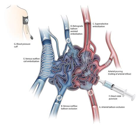 Peripheral Arteriovenous Malformations Classification And Endovascular