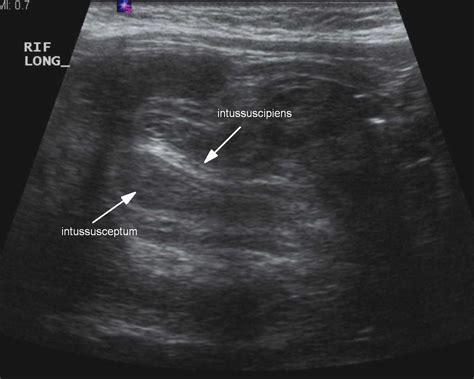 Intussusception Ultrasound Protocol