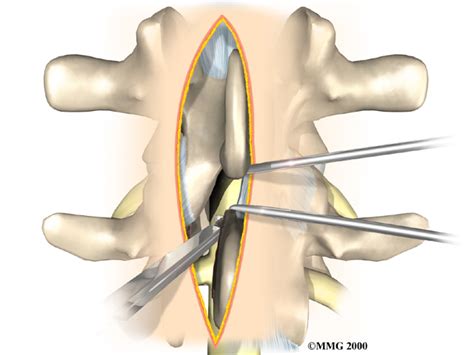 Lumbar Laminectomy Surgery Recovery Physical Therapy In Greenville