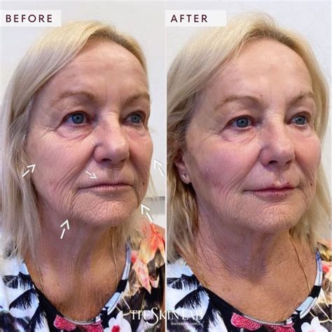 Before After Time Our Signature Liquid Facelift Performed By The Exceptionally Talented