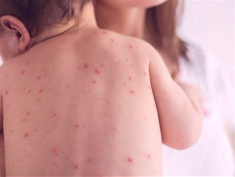 ХӨСҮТ Улаанбурхан өвчний лабораториор батлагдсан 2296 болжээ