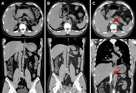 Figure5 Computed Tomography Findings Of Calcification In The Inferior Download Scientific