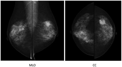 Palb2 Mutation In A Woman With Bilateral Breast Cancer A Case Report