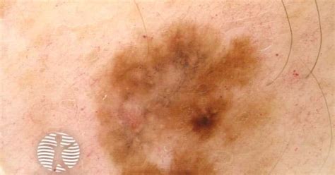 Dermoscopy Mixed Pattern Melanoma Image