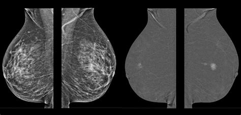 Breast Cancer Digital Mammogram