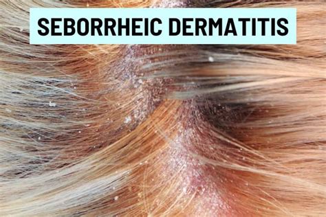 Red Spots On Scalp 11 Causes Pictures And Treatment