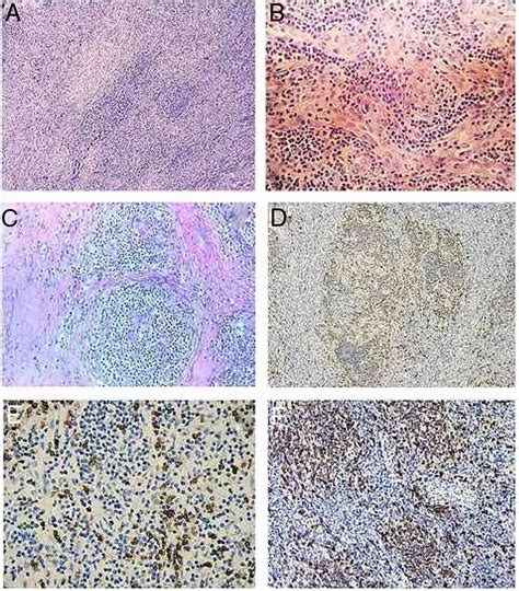 Follicular Dendritic Cell Sarcoma Aggravated By Hyaline Vascular Castlemans Disease In