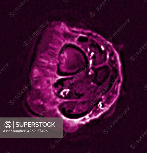 Epidermoid Carcinoma Colored Enhanced Axial Computed Tomography Ct Scan Of The Calf Showing A