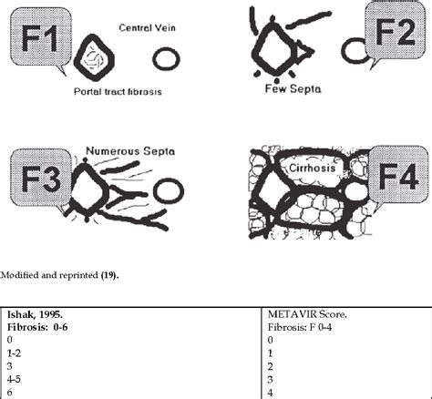 Table 1 From 10 Ishak Versus Metavir Terminology Convertibility And Correlation With