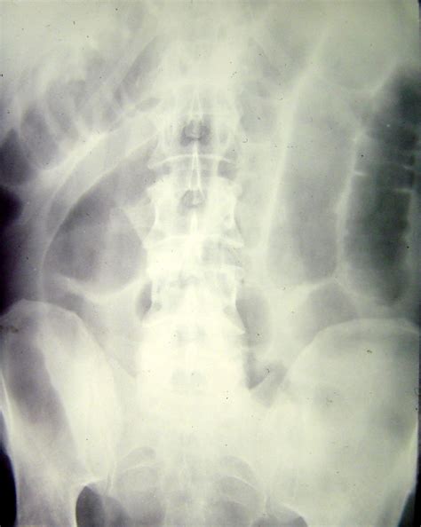 Small Bowel Infection 3662 Campylobacter Enteritis Surgery Photos