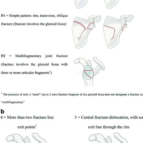 A B Arbeitsgemeinschaft Für Osteosynthesefragen Ao Glenoid Download Scientific Diagram