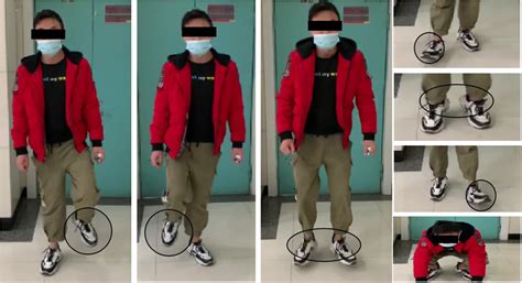 Both Lower Limb Motor Nerve Functions Recovered 12 Months After The Download Scientific Diagram