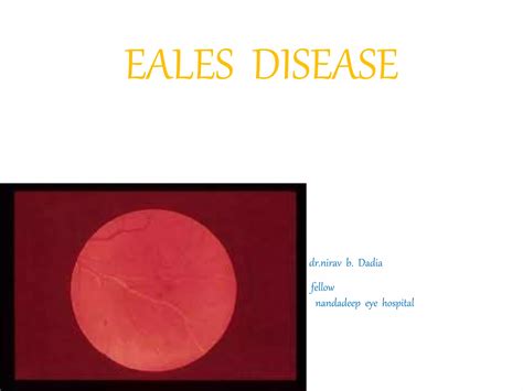 Eales Disease Pptx