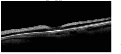 Fileinner Retinal Hyperreflectivity Crao Eyewiki