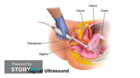 Pelvic Ultrasound Procedure Preoperative Ultrasound Assessment Of