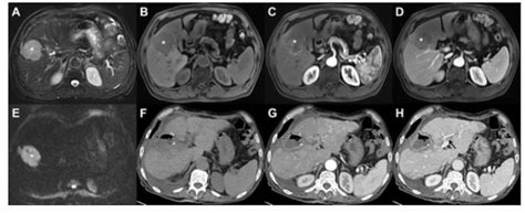 Emerging Model With Key Mri Feature Improves Prediction For Advanced