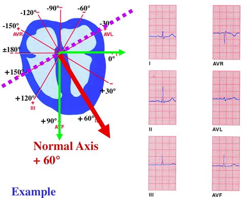 Normal Ecg P R T Axes At Liam Threlfall Blog