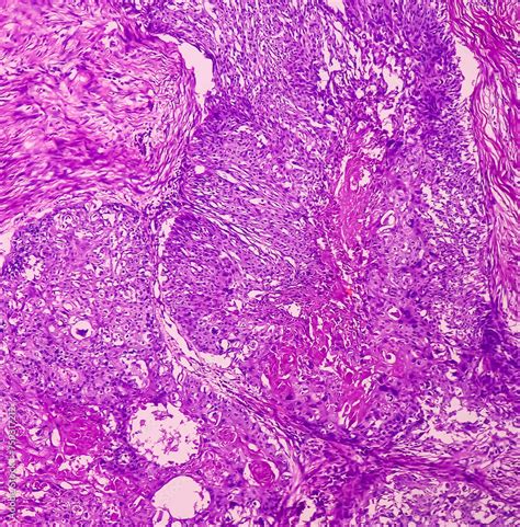 Nipple Biopsy Invasive Squamous Cell Carcinoma Of Nipple