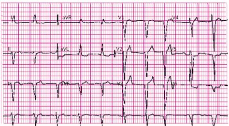 Qrs Complex Abnormalities Causes Ecg Patterns And Treatment