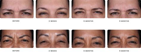 Daxxify Boston Fine Lines And Wrinkles Wellesley