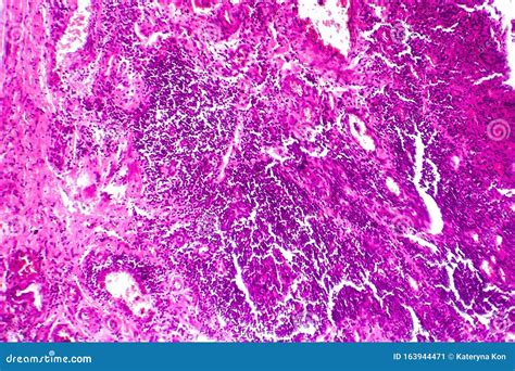 Bladder Cancer Light Micrograph Stock Image Image Of Medicine Neoplasm 163944471