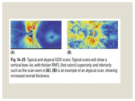 Imaging In Glaucoma Pptx