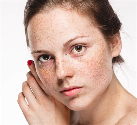Lots Of Freckles On Face
