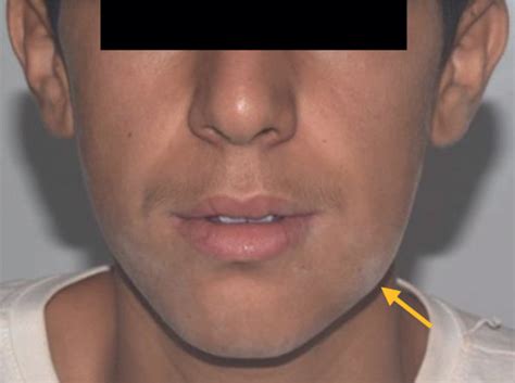 Extraoral Examination Revealed A Left Mandibular Swelling Download Scientific Diagram