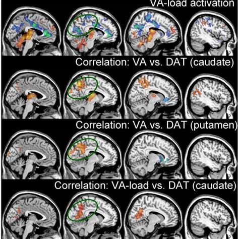 Sagital Views Of The Brain Activationcorrelation Patterns During Va