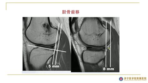 图文并茂：膝关节mri解剖及常见病诊断 Medscicn
