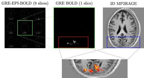 Exemplary Functional And Anatomical Localization Data From An Oblique Download Scientific
