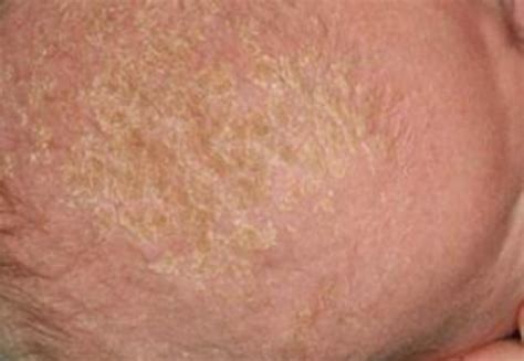 Dermatitis Flashcards Quizlet