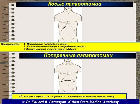 Лапаротомии презентация онлайн