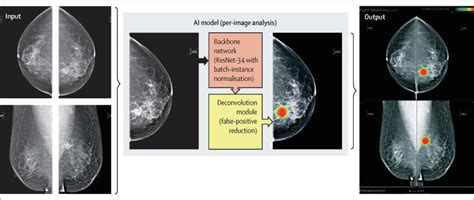 Ai Enhanced Breast Imaging Where Are We And Where Are We Heading