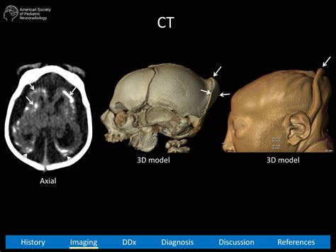 6 Month Old Girl With Severe Microcephaly At Birth Mother Had Traveled