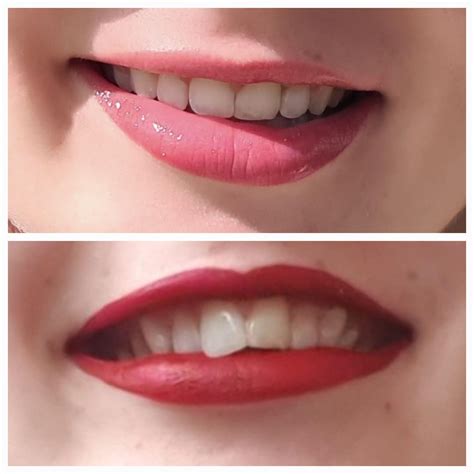 Just Got My Braces Off Rbraces