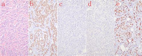 Scalp Metastasis After Breast Cancer Surgery A Case Report Ott