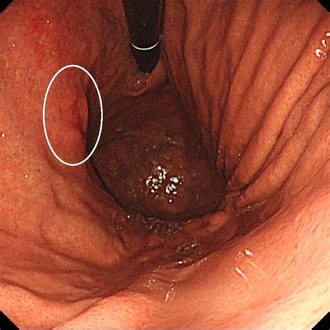 Upper Gastrointestinal Endoscopy Upper Gastrointestinal Endoscopy Download Scientific Diagram