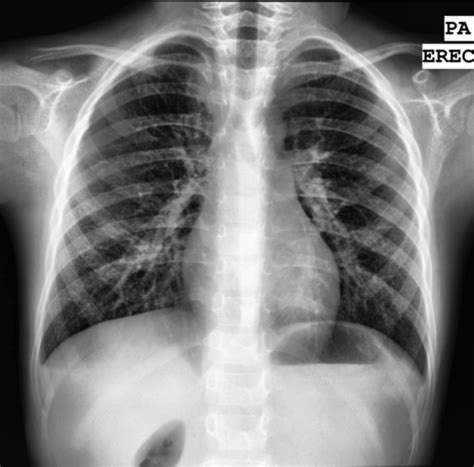 Unet Segmentation Object Detection Dataset By Segmentation Cxr