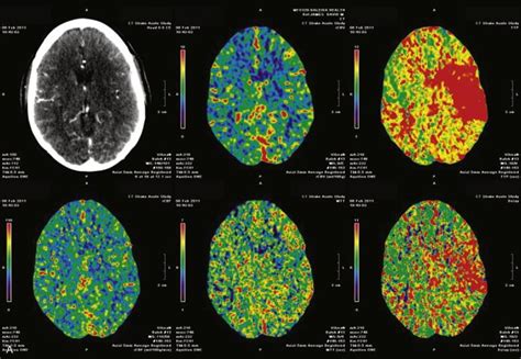 Carotid Endarterectomy Or Stenting For Evolving Stroke Secondary To
