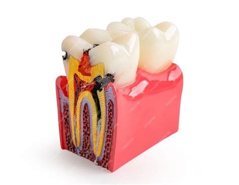 Premium Photo Tooth Decay Dental Implant Artificial Tooth Roots Into