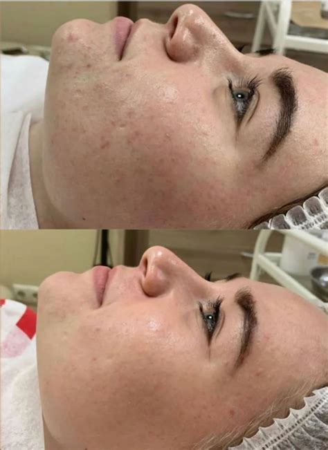 Prx T33 Peel Face Treatments ⚕️london Cost £75 Before And After