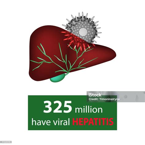 Ilustración De 325 Millones Tienen Hepatitis Viral Virus Del Hígado Y