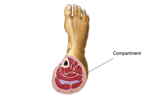 Compartment Syndrome Wikidoc