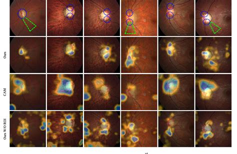 Figure 8 From A Large Scale Database And A Cnn Model For Attention Based Glaucoma Detection
