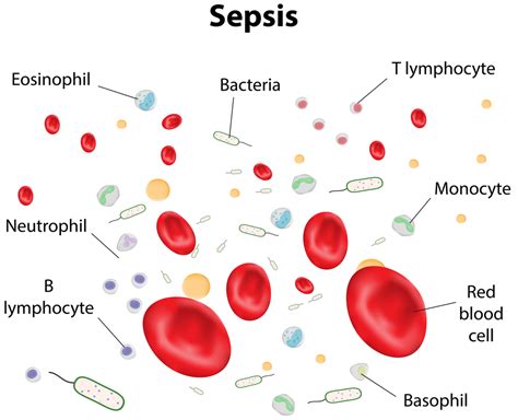 A Novel Therapy For Sepsis ThirdAGE Healthy Living For Women Their Families