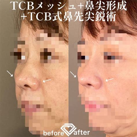 症例写真 ：tcbメッシュ 美容整形はtcb東京中央美容外科