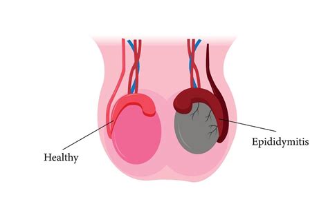 Swollen Epididymis Symptoms