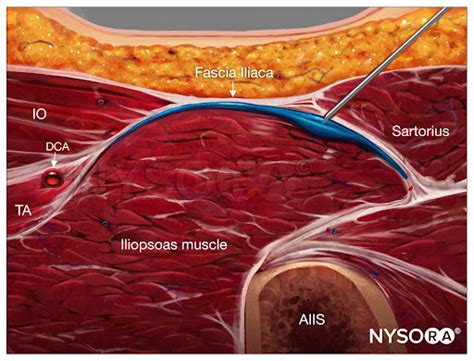 4 Sonoanatomy Of The Fascia Iliaca Compartment Block