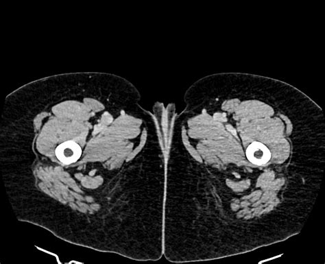 File Choledocholithiasis Cholangitis And Portal Vein Thrombophlebitis